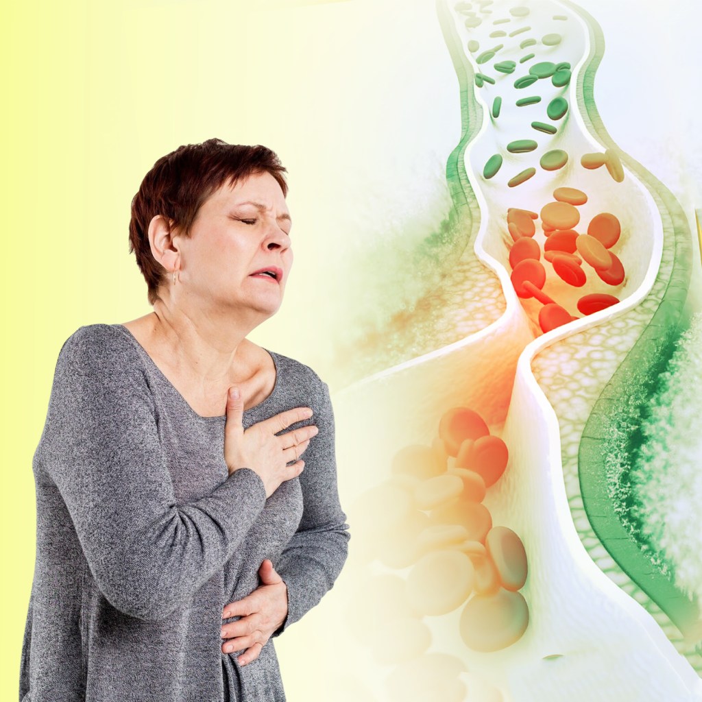 Hyperlipidemia & Cholesterol